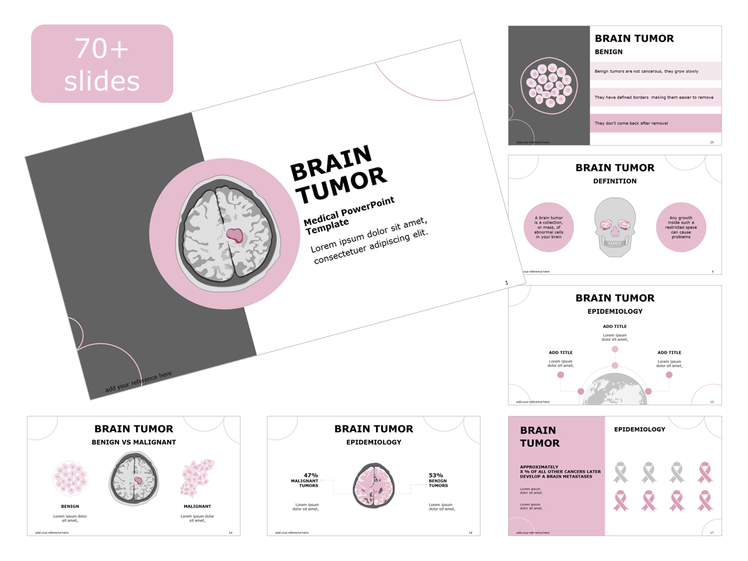 Brain Tumor PowerPoint Template - RxSlides - The largest online store for medical PowerPoint ...